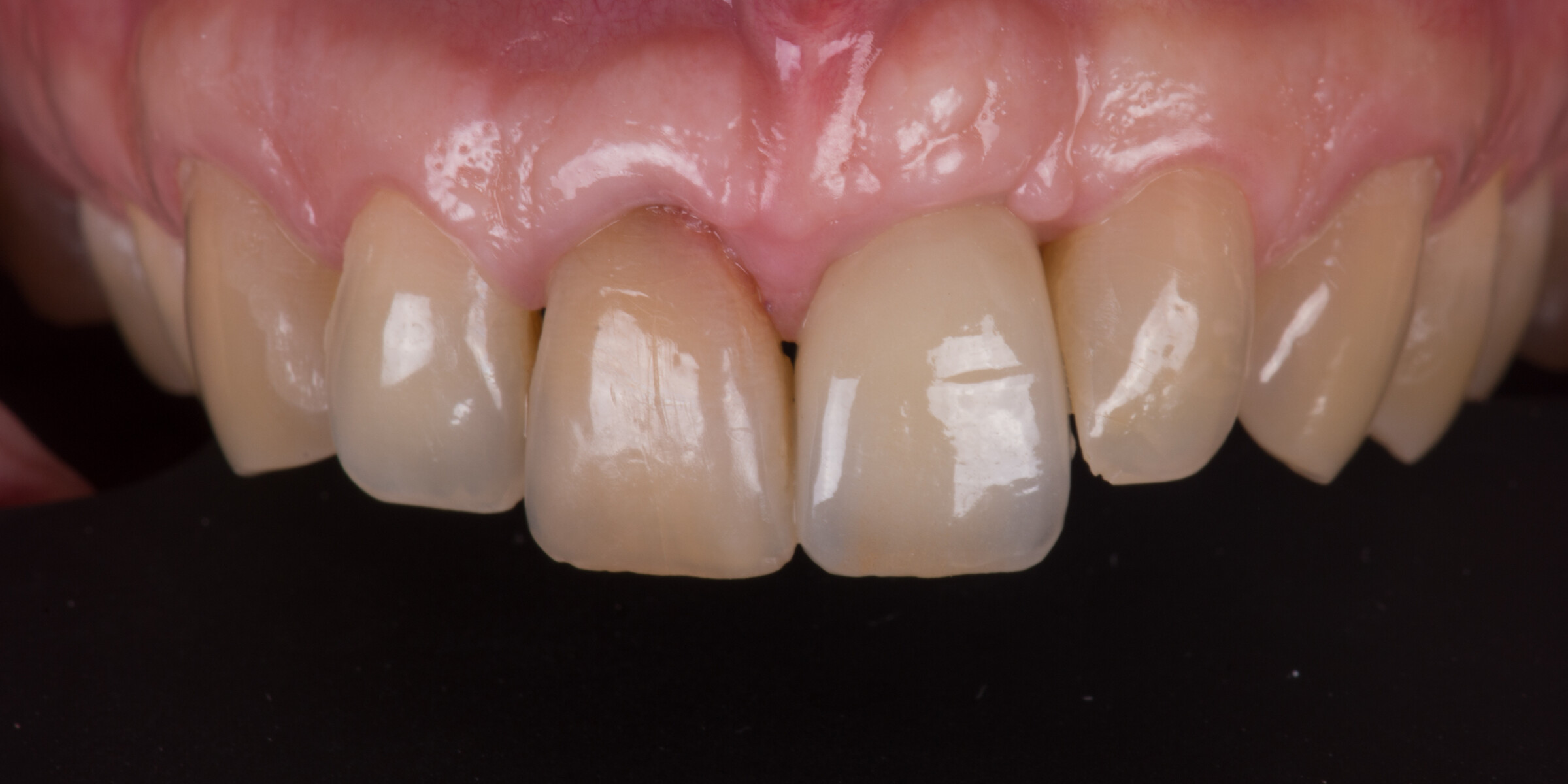 Immediate placement and restoration of a Straumann BLX implant ...