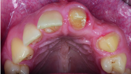 Reconstruction of a horizontal ridge defect using the bone lamina technique