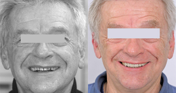 Smile Design Wheel: A simplified protocol for smile design