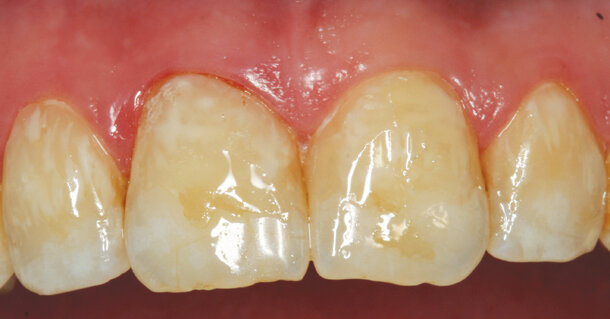 Dental News - Caries removal and esthetic direct composite restorations
