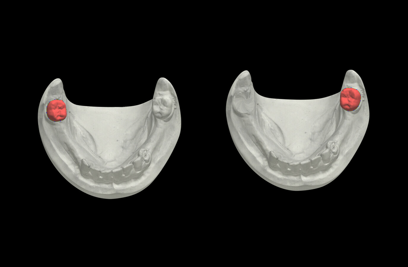 Ivoclar – Production of the interim denture with Digital Denture