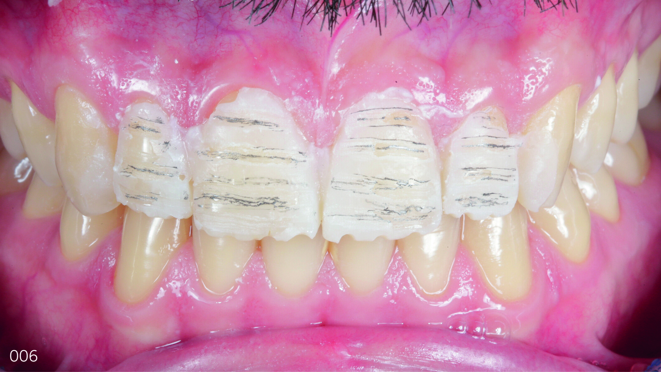 DT News - International - Extremely minimally invasive mock-up-guided ...