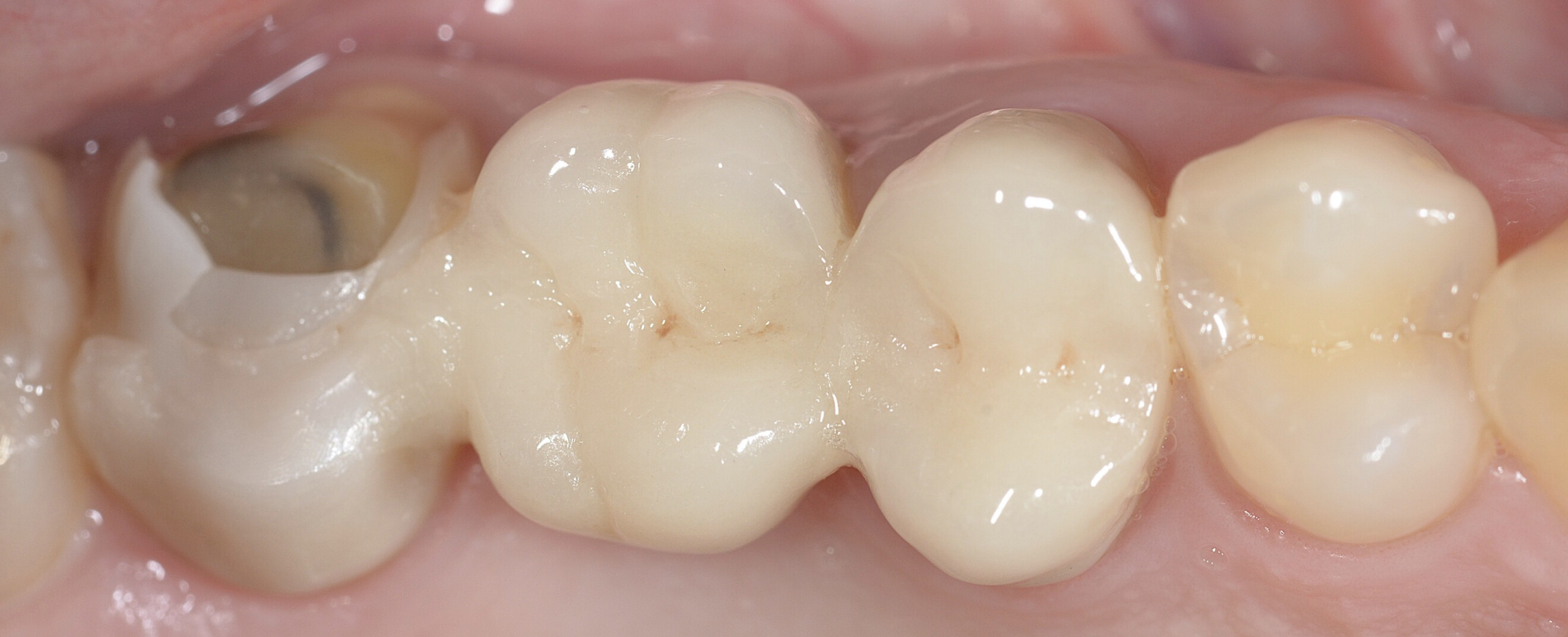 A three-unit bridge restoration of a fractured ceramic crown