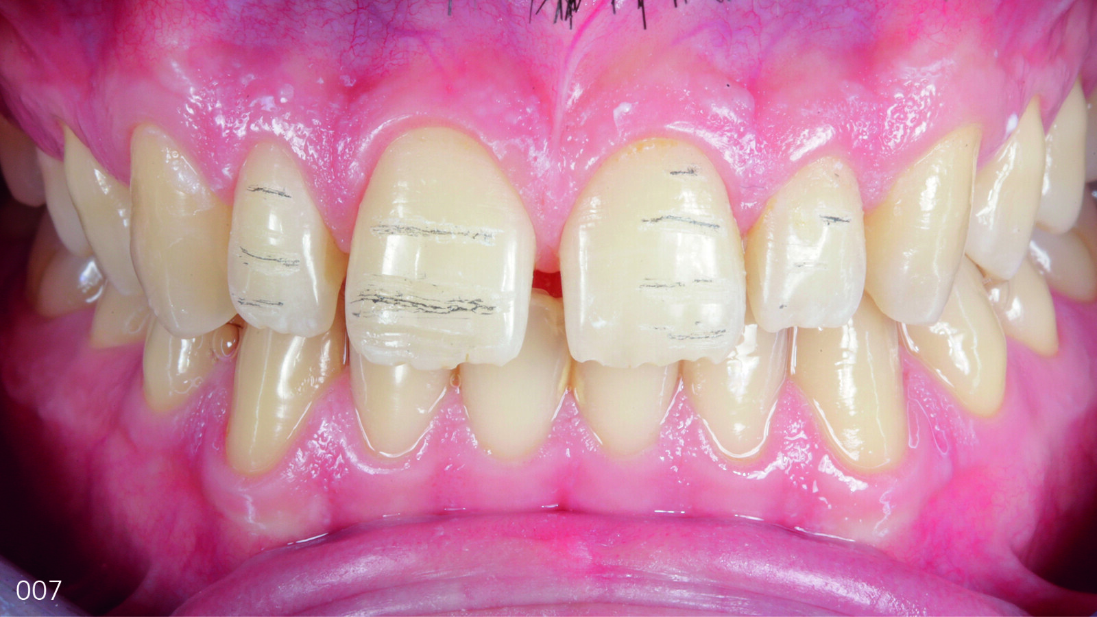 DT News - International - Extremely minimally invasive mock-up-guided ...