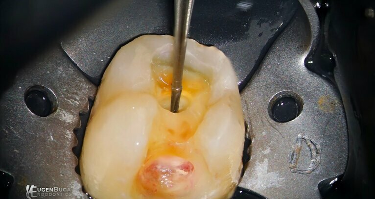 Endodontics and working length determination