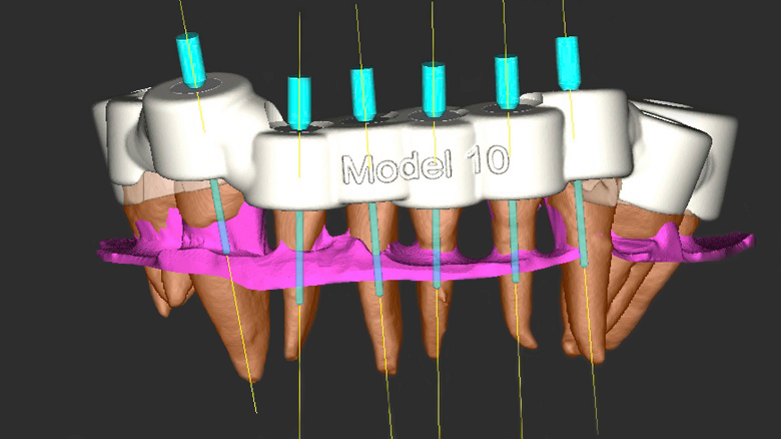 Research team receive multiple awards for micro-guided endodontics ...
