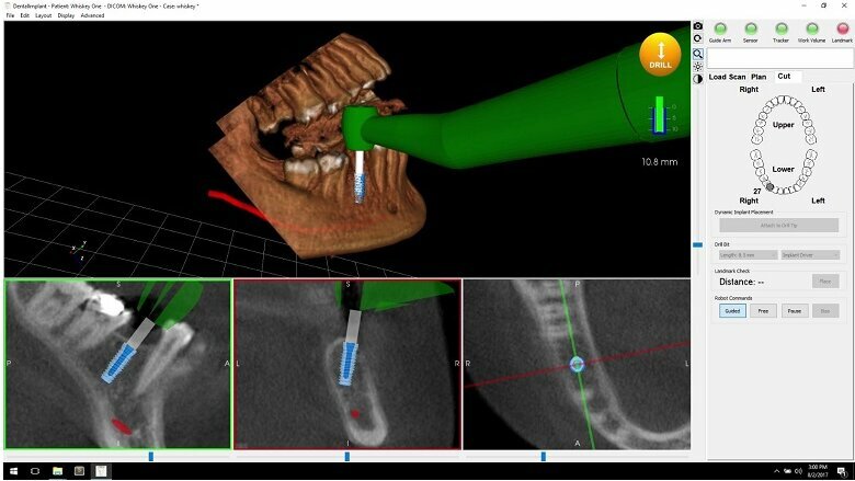 Neocis reaches first commercial milestone for Yomi surgical system