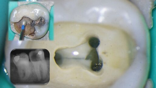 Dental News - Three questions about the management of complex root ...