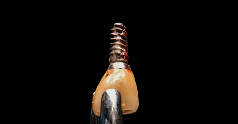 Altered biomaterials reduce risk of dental implant rejection