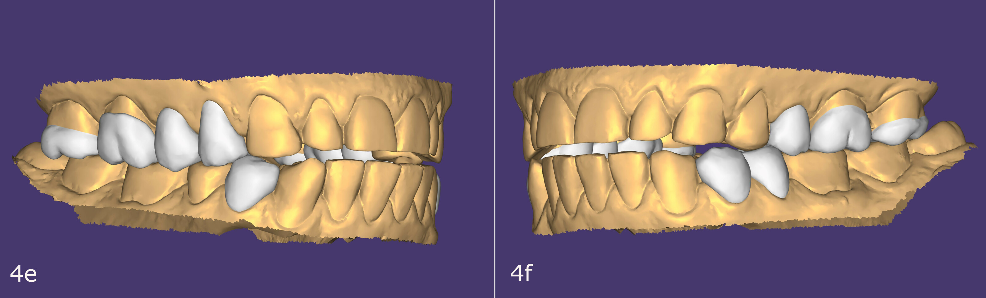 An aesthetic, minimally invasive restoration