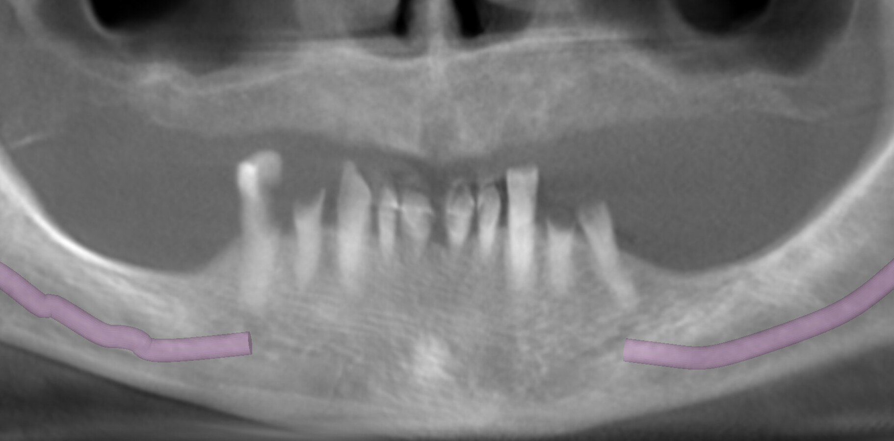 Straumann Pro Arch concept with fully guided implant and abutment placement