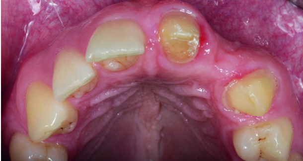 3-D alveolar ridge reconstruction in a case with severe bone loss