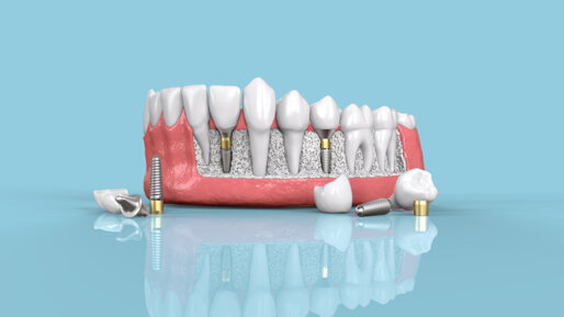 Researchers review dental implant placement using flapless versus ...