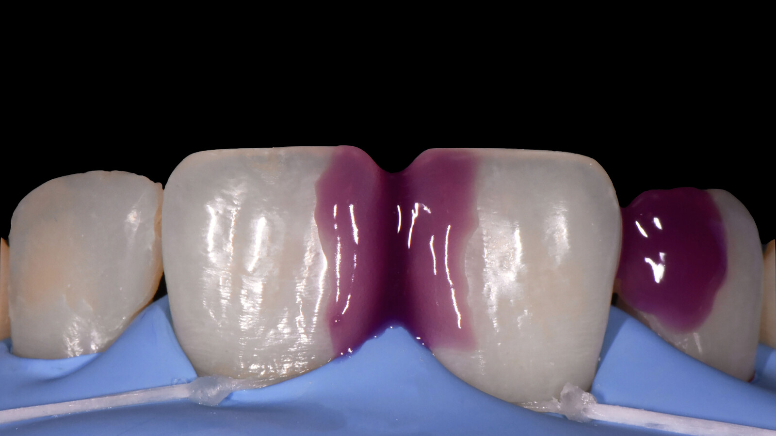 Diastema closure using a direct two-matrix technique