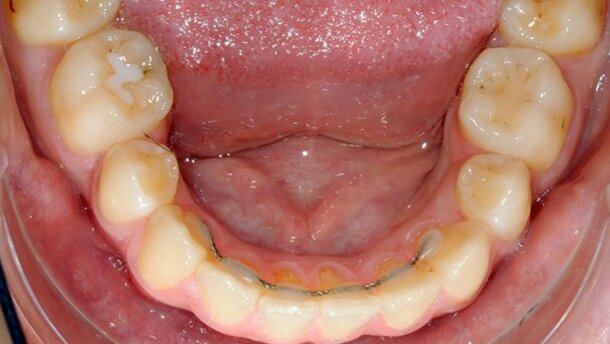 Procédure optimisée de collage d’un fil de contention