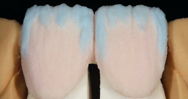 Smile analysis and photoshop smile design technique