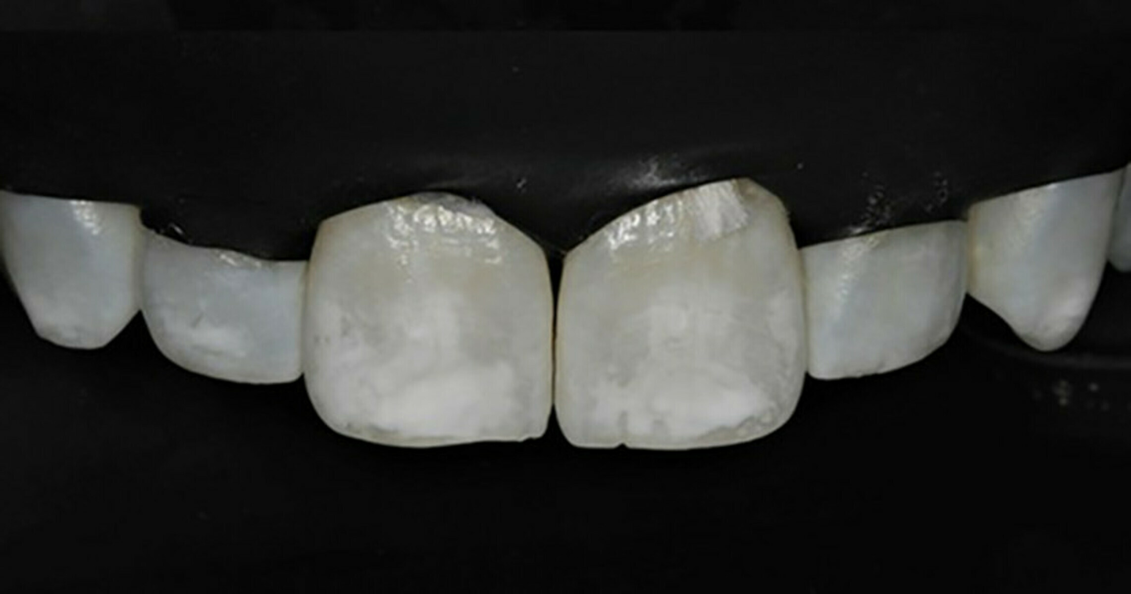 DT News - US - Conservative aesthetic management of white spot ...