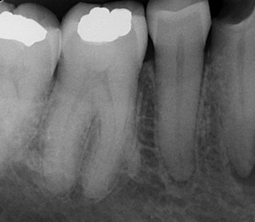 Shaping a Type V mandibular premolar with VDW.ROTATE