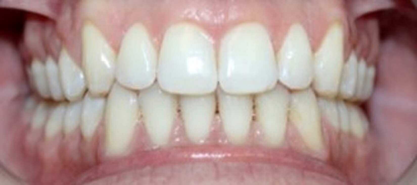 Clear aligners: Minimising attachments for optimal results