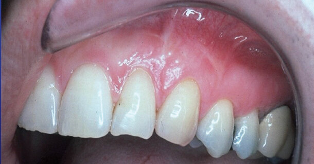 DT News - US - Cosmetic periodontal surgery: Multiple gingival graft ...