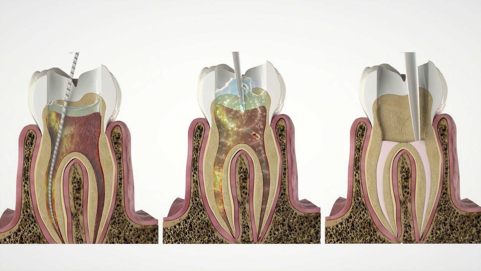 Dental News - Discover SWEEPS for a more effective endodontic treatment ...