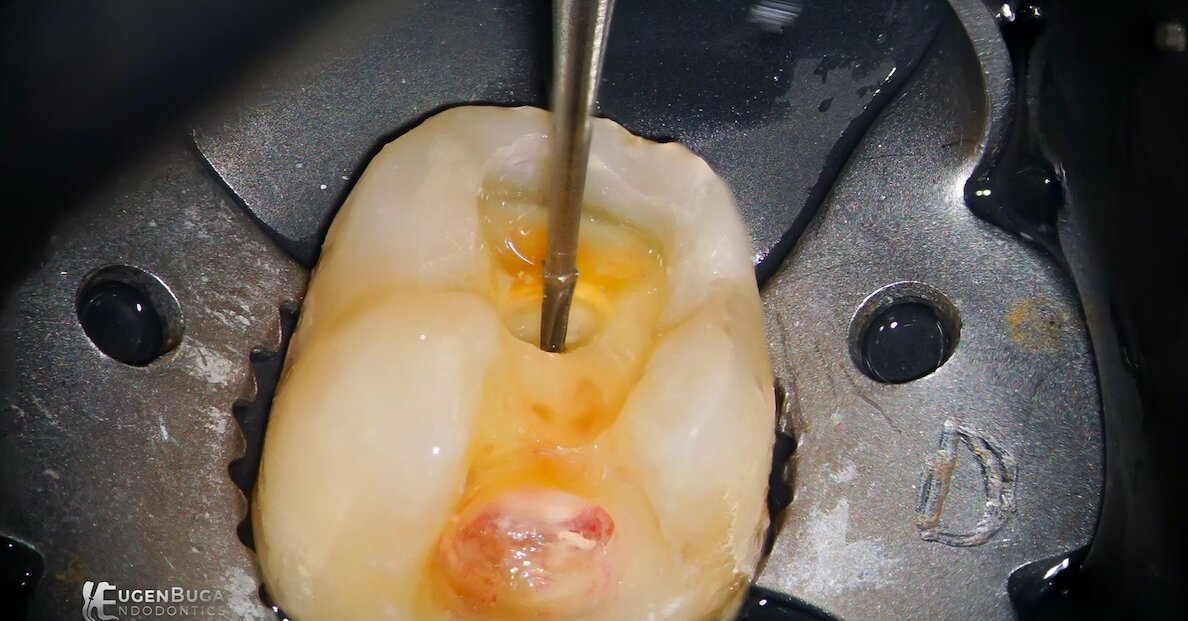 Guide to achieving fast and efficient precision in endodontics