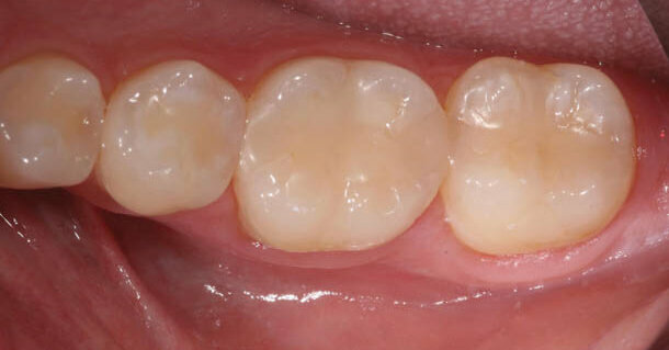 Dental News - Nanohybrid composite solutions that patients love