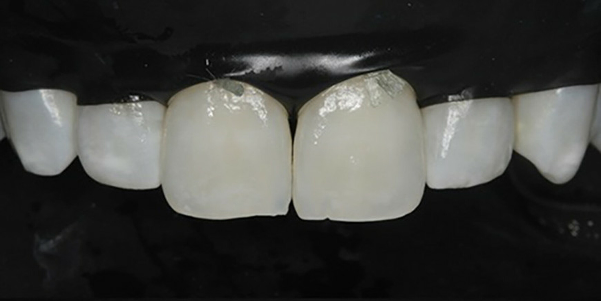 DT News - US - Conservative aesthetic management of white spot ...