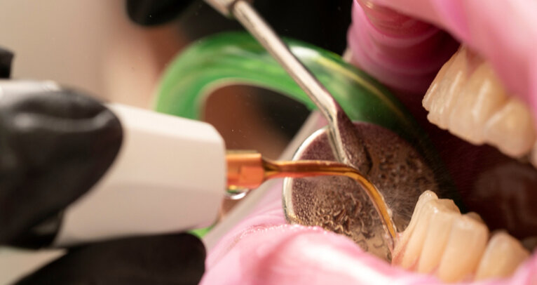 Hybrid shaping with MG3 rotary system