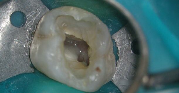 Twisted Files changed the world of endodontics - case report