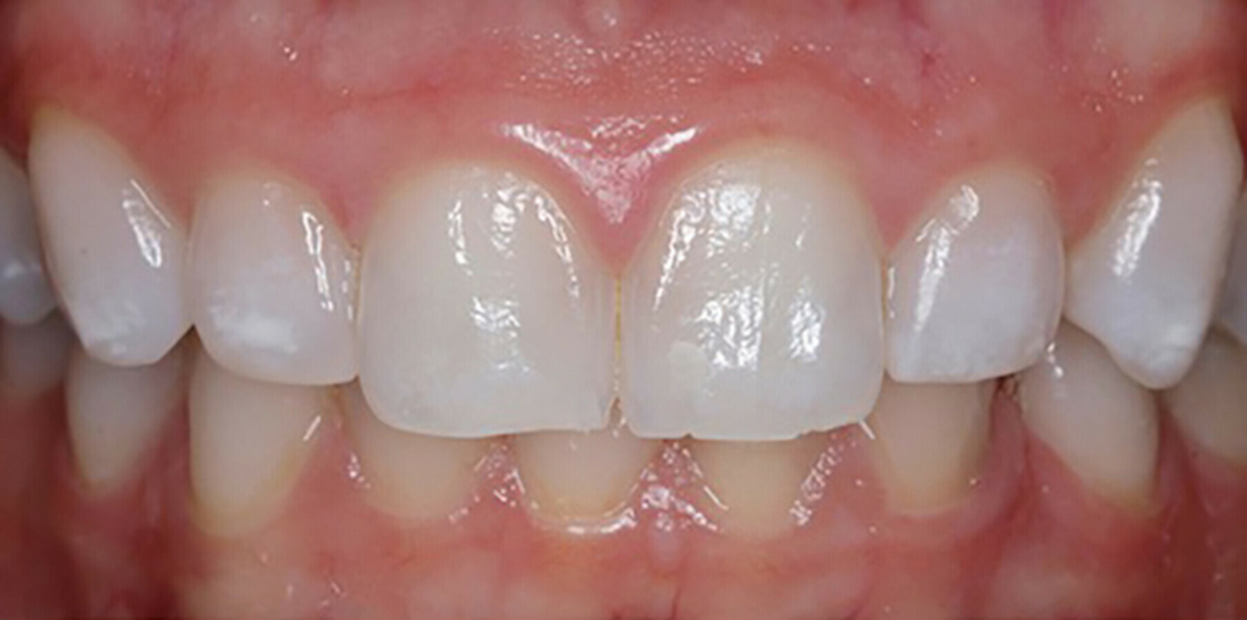 DT News - International - Conservative aesthetic management of white ...