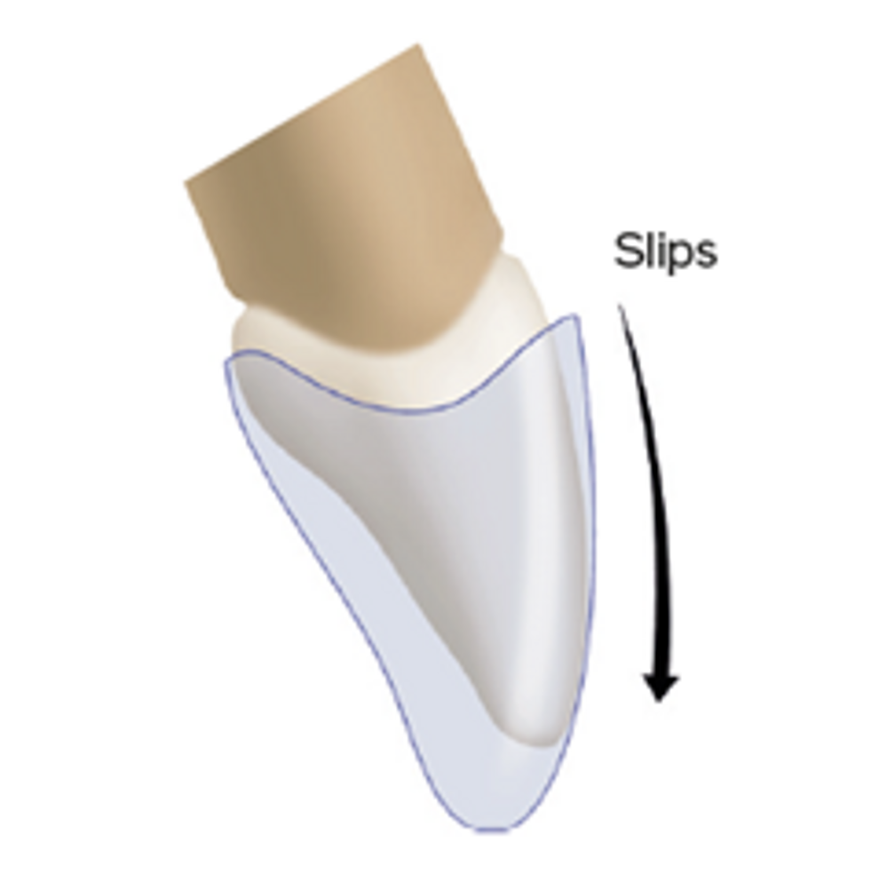 Clear aligners: Minimising attachments for optimal results