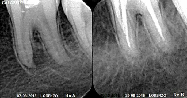 DT News - Latin America - Tratamiento de procesos periapicales con ...