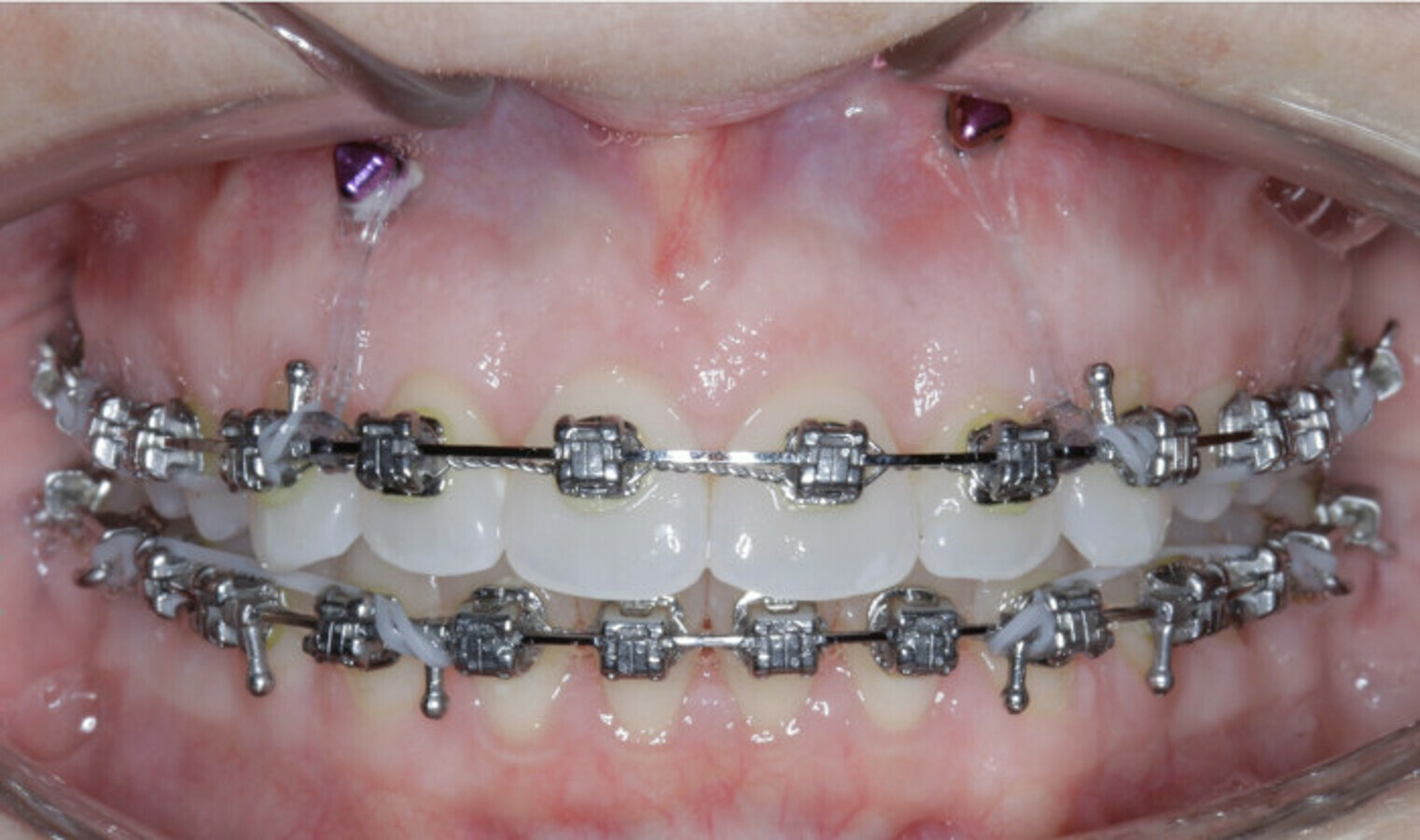 New Age orthodontics and orthopaedics with temporary anchorage devices