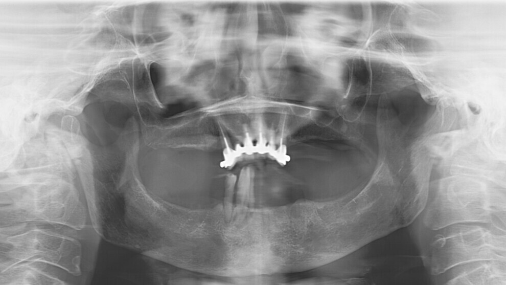Implant treatment of the fully edentulous patient