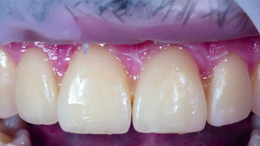 DT News - International - Extremely minimally invasive mock-up-guided ...