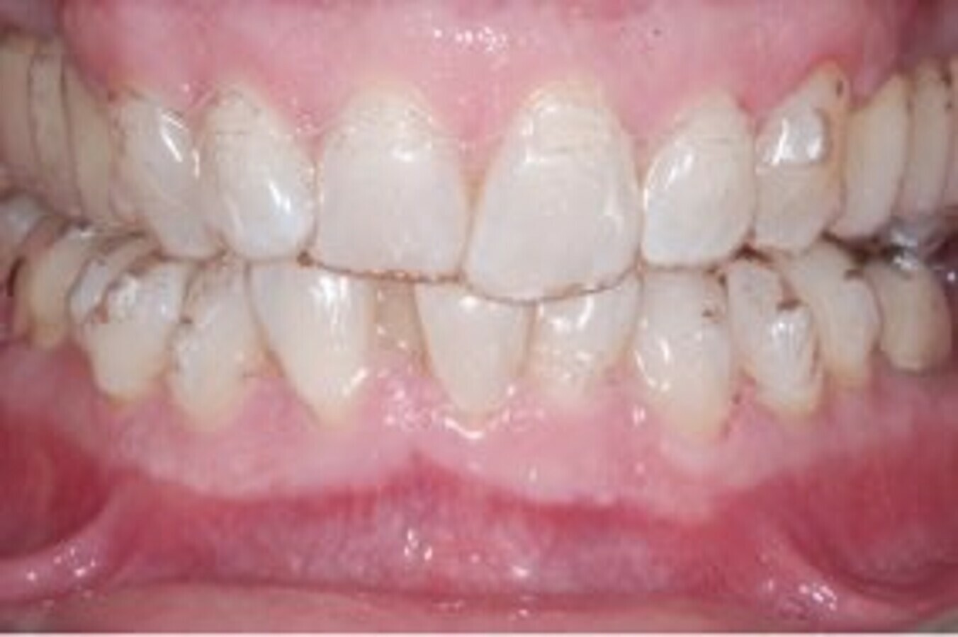 Proper curve of Spee levelling