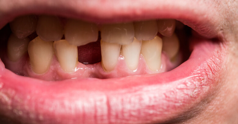 Smoking cessation may decrease risk of tooth loss