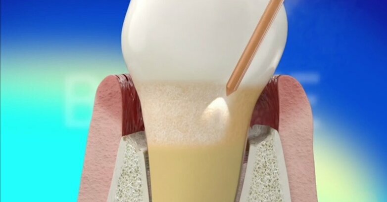 DT News - International - BIOLASE REPAIR Perio protocol shows superior ...