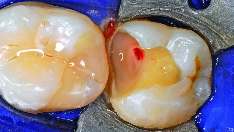 Dental News - 3D Endo Software, glide path management and WaveOne Gold