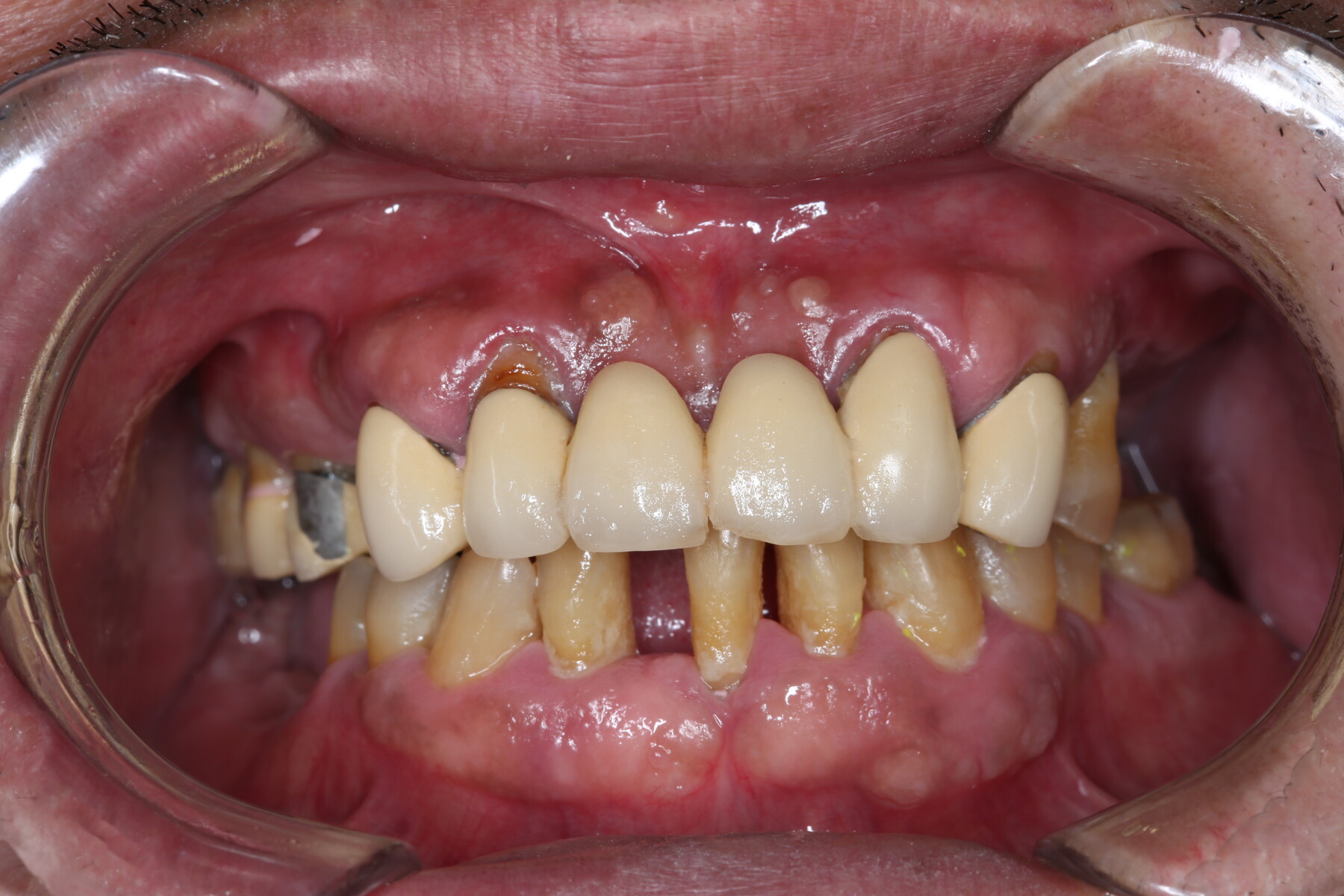 Compromised maxillary dentition treated with Straumann Pro Arch and a ...