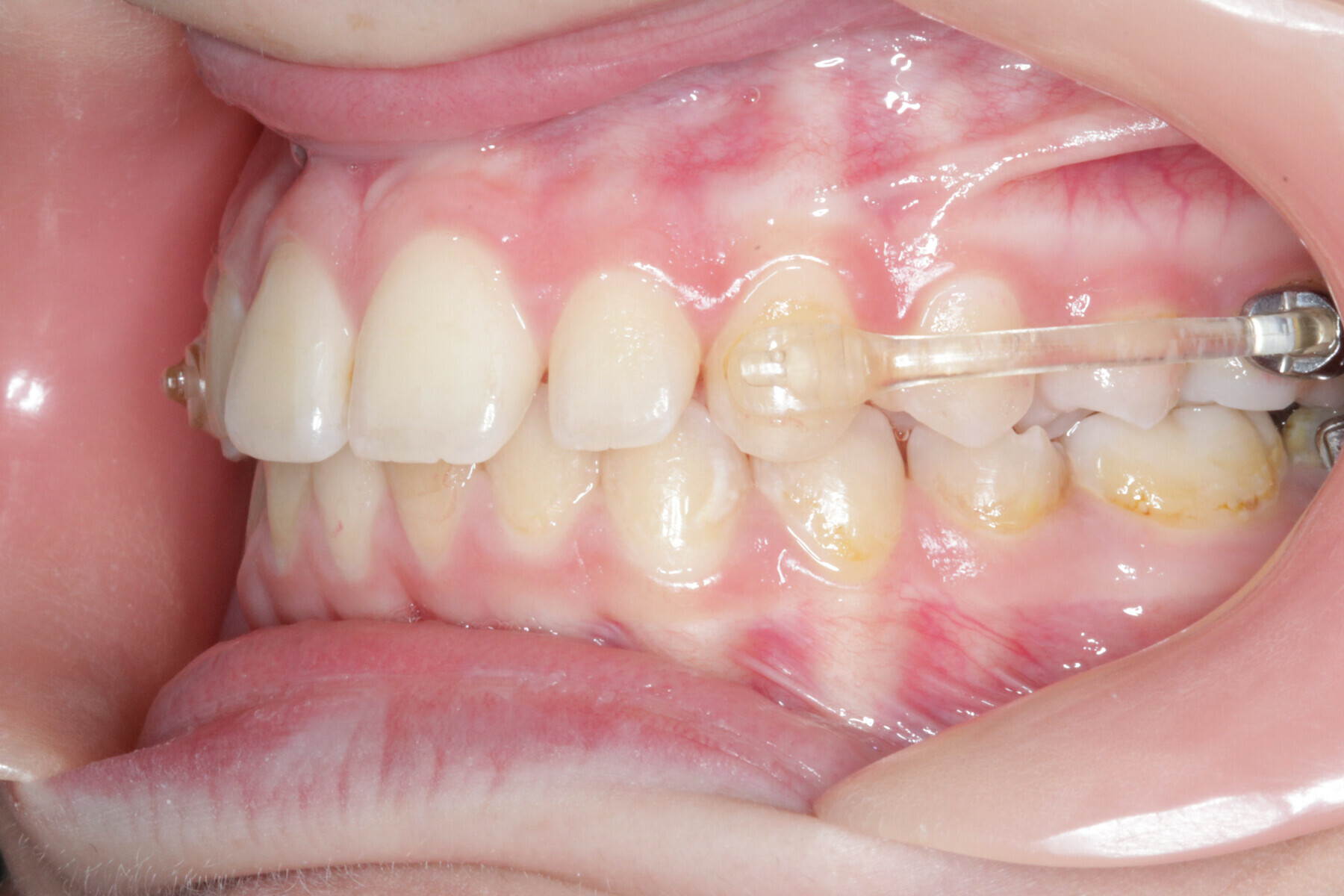 Boosting facial aesthetics through a hybrid approach of the Carriere ...