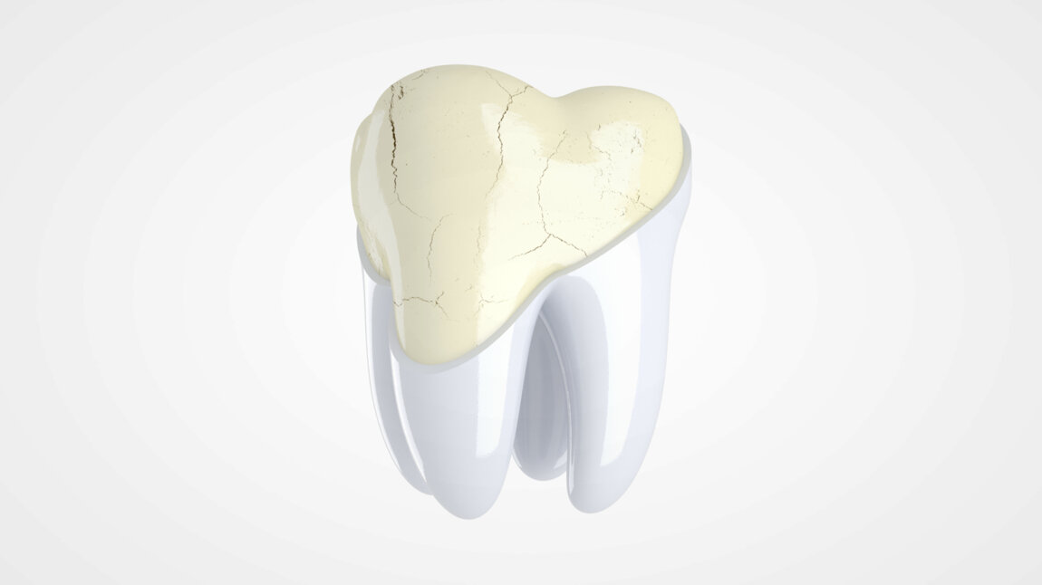 Mechanism behind tooth enamel disorder in coeliac disease