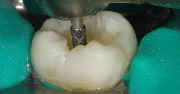 Dental News - Evolving conservative dentistry