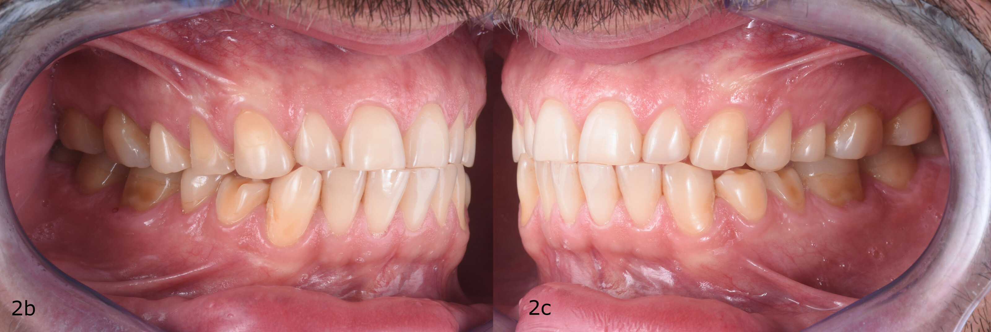 An aesthetic, minimally invasive restoration
