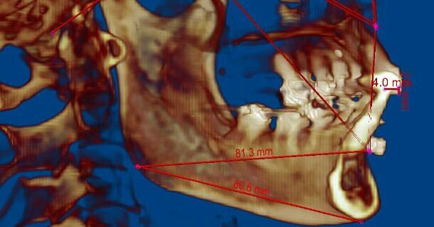 Nova tecnologia melhora alinhamento da mandíbula e dos dentes em ...