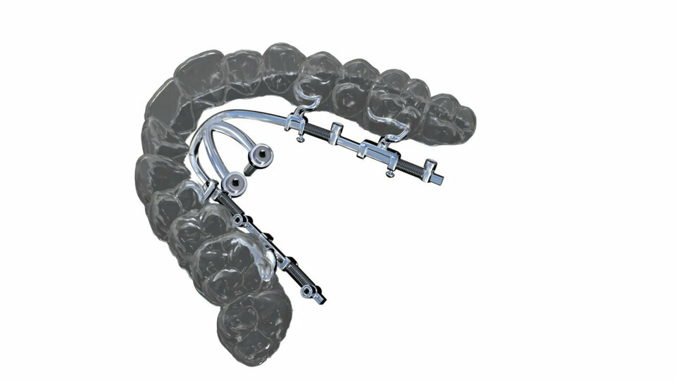 Aligner therapy: mini-implant-borne sliders and expanders