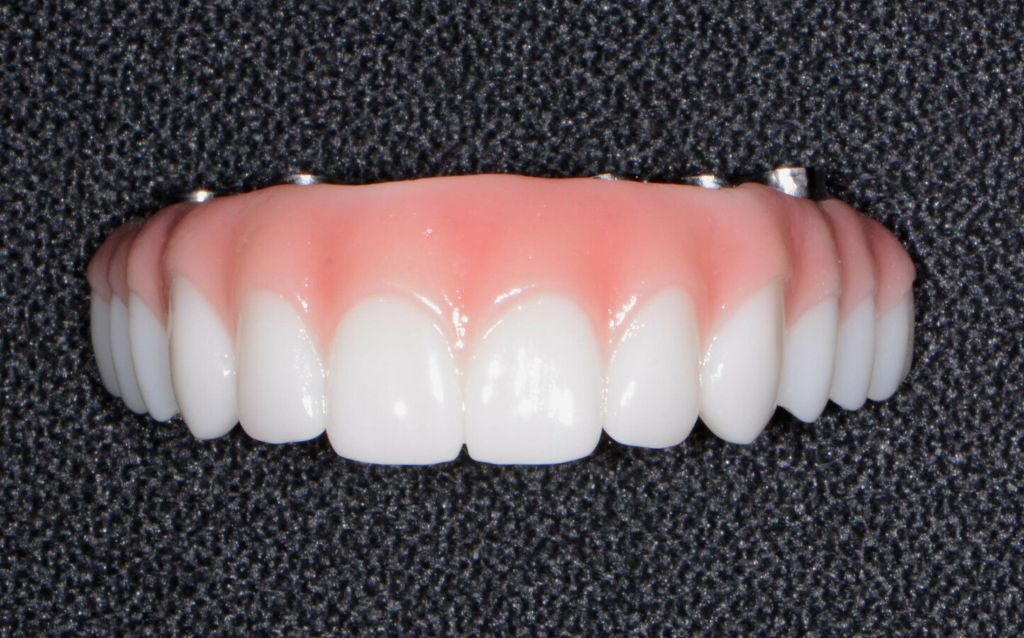 DT News - International - Full-arch CBCT-guided implant rehabilitation