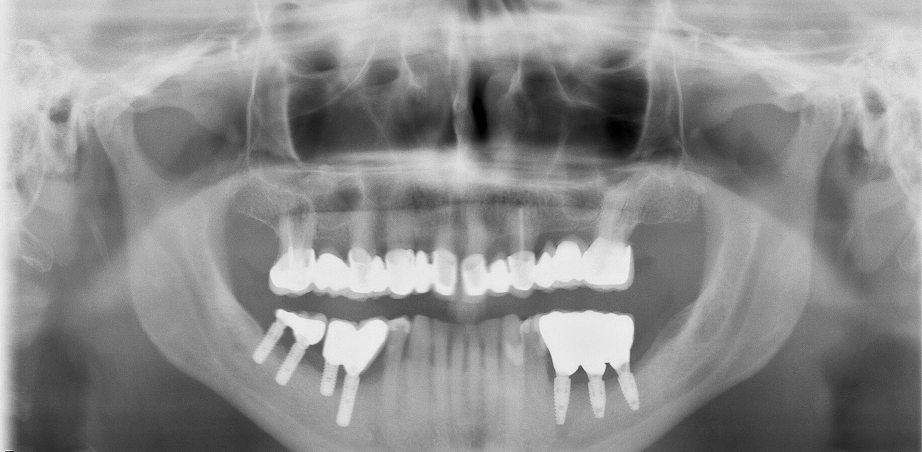 Guided bone regeneration in smokers - Use of synthetic bone blocks