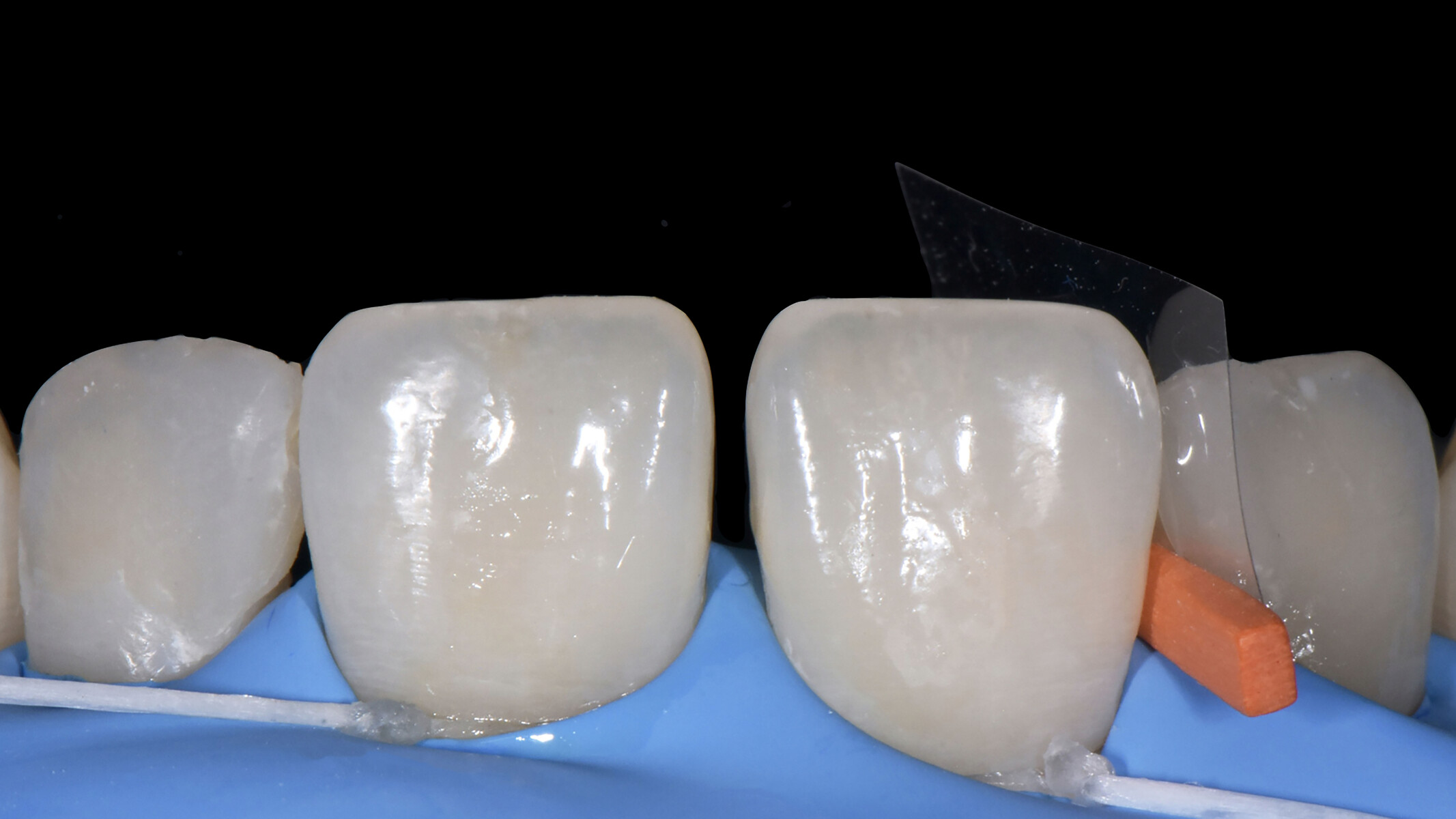 Diastema closure using a direct two-matrix technique